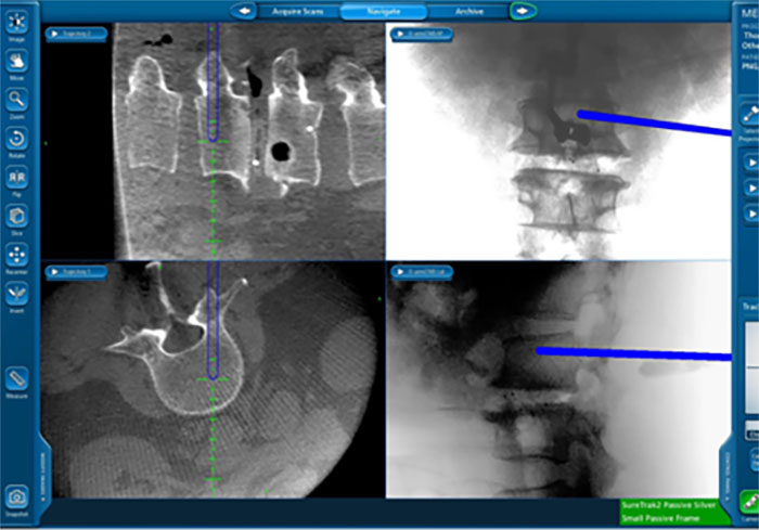 Advances in Spinal Surgery ex minimally invasive spine surgery | PTL ...