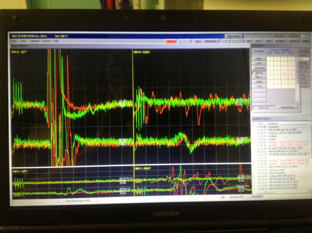Advances in Spinal Surgery ex minimally invasive spine surgery | PTL ...