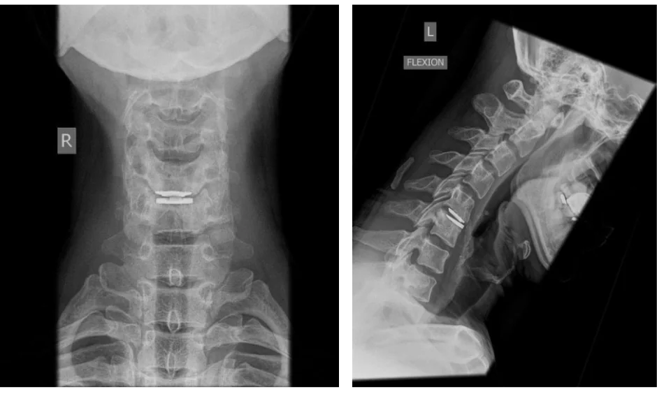 Advances in Spinal Surgery ex minimally invasive spine surgery | PTL ...